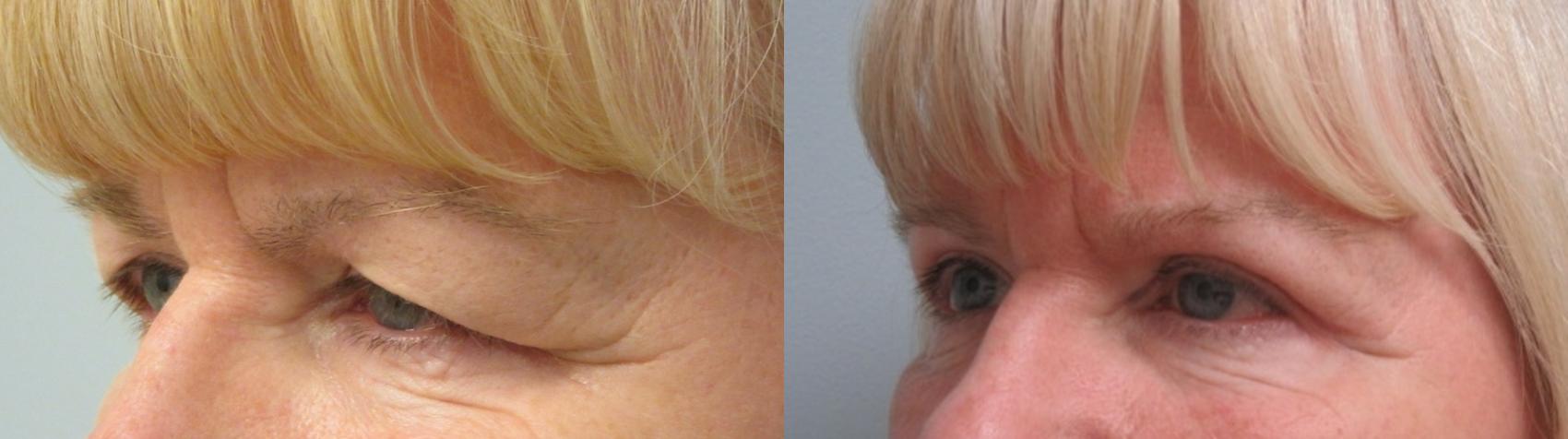 Eyelid Surgery Before and After Pictures Case 52 | Anchorage, AK ...