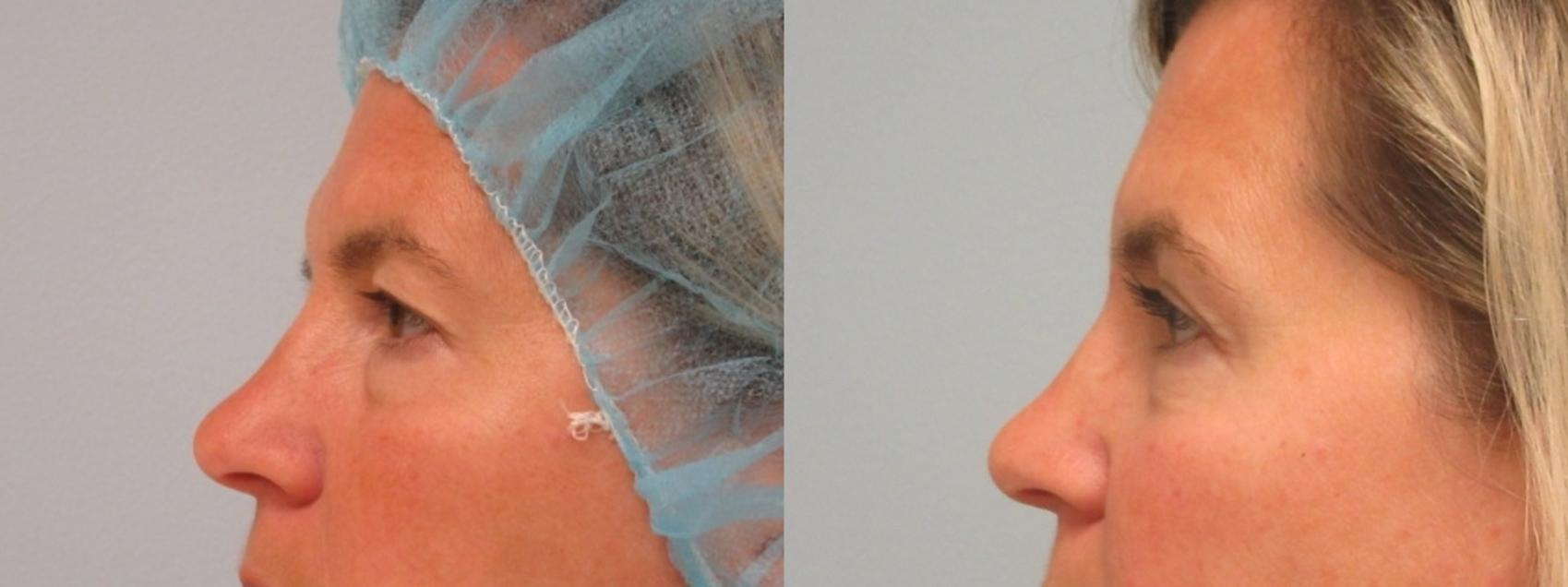 Eyelid Surgery Before and After Pictures Case 72 | Anchorage, AK ...