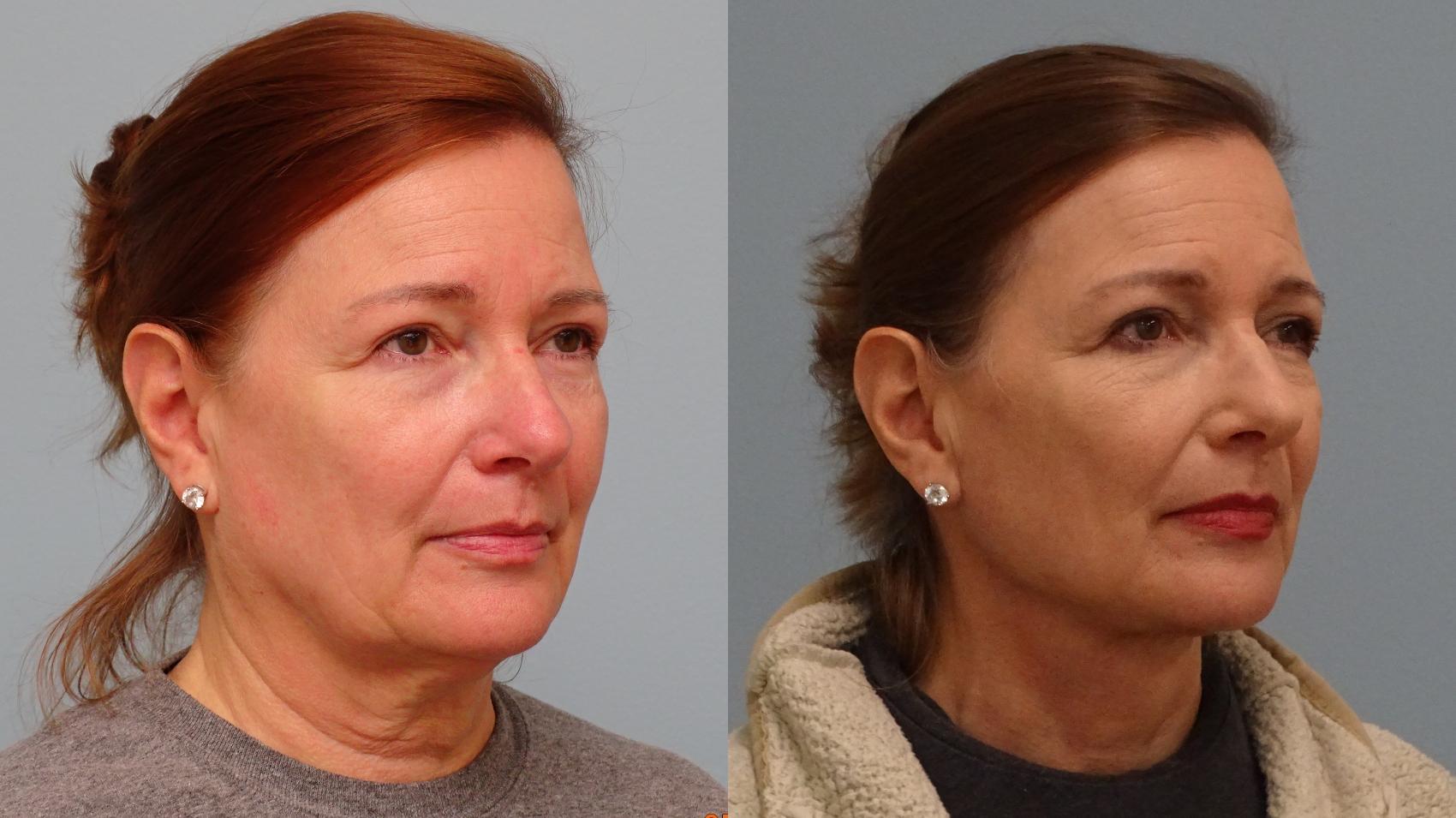 Facelift & Neck Lift Before and After Pictures Case 78 | Anchorage, AK ...